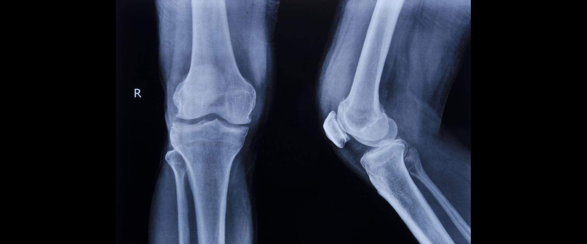 Reducing Racial Disparities in Knee Pain using Artificial Intelligence ...